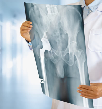 Defective Hip Replacement Lawyer | Manchin Injury Law Group